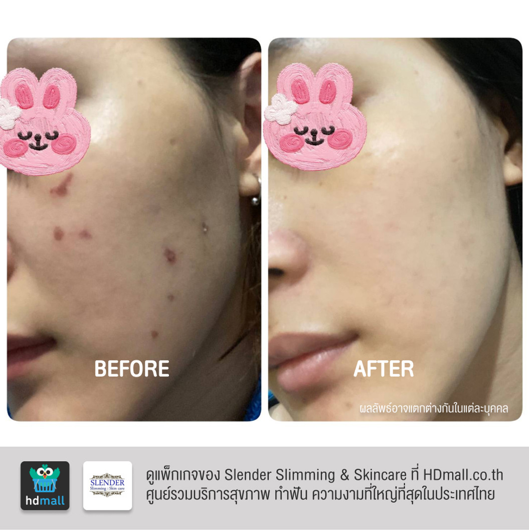 คอร์สฉายแสงฆ่าเชื้อสิว ด้วย Blue Light Laser ลดการอักเสบ ทำให้สิวฝ่อและ ...