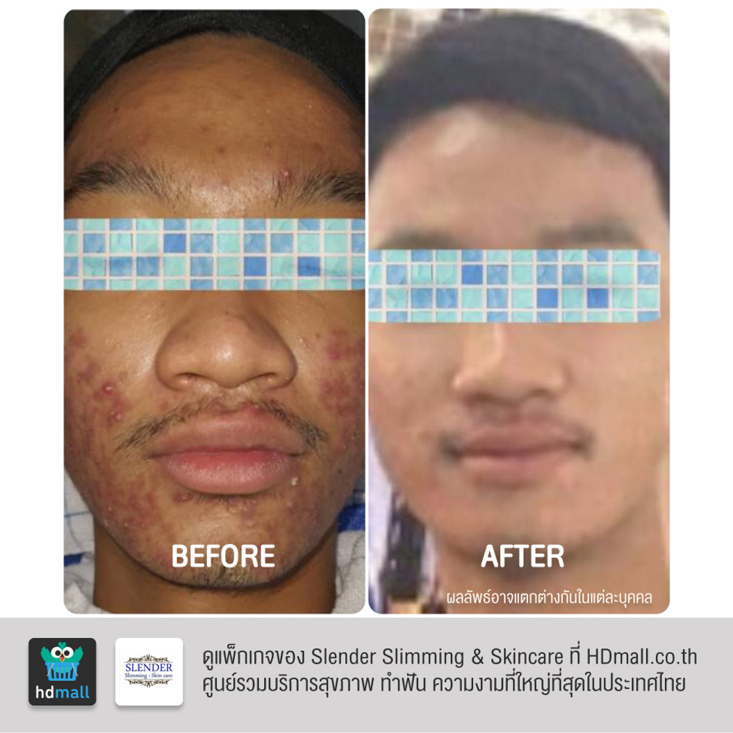 คอร์สฉายแสงฆ่าเชื้อสิว ด้วย Blue Light Laser ลดการอักเสบ ทำให้สิวฝ่อและ ...