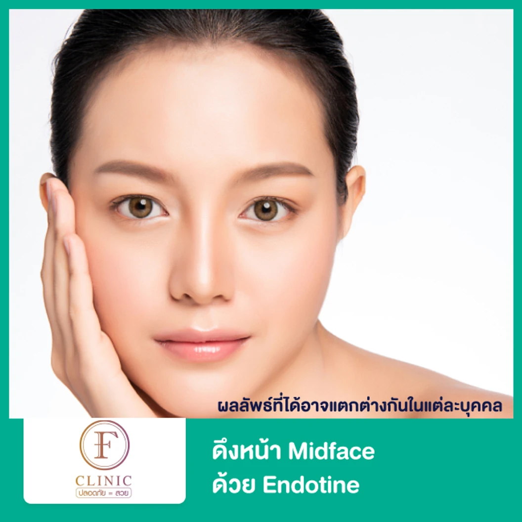 ดึงหน้า Midface ด้วย Endotine ที่ F Clinic - ราคา 2567 (2024) | HDmall
