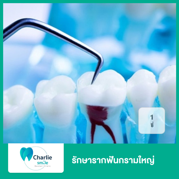รักษารากฟันกรามใหญ่ 1 ซี่ ที่ Charlie Smile Dental Clinic - ราคา 2567 (2024) | HDmall