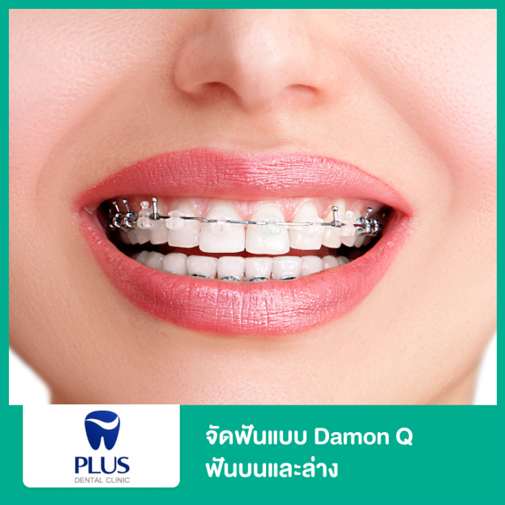 จัดฟัน Damon Q ฟันบนและล่าง เฉพาะสาขาบางนาเท่านั้น! (ราคาพิเศษสำหรับลูกค้าที่ชำระทั้งคอร์ส) ที่ ...