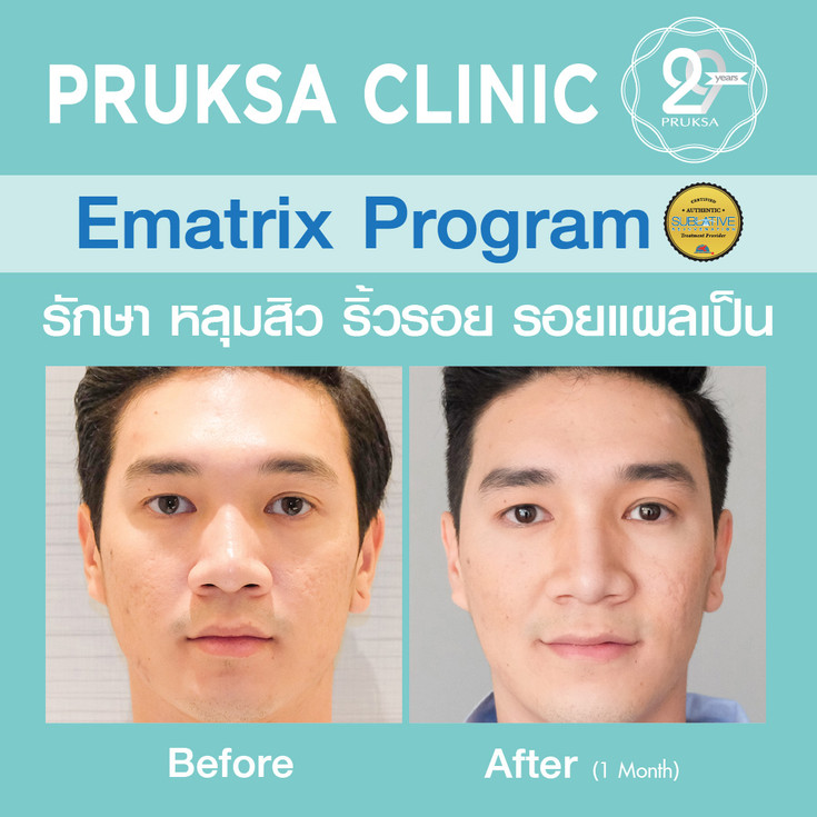 เลเซอร์ E-Matrix แก้ปัญหาหลุมสิว ผิวขรุขระ รูขุมขนกว้าง 100 ช็อต 1 ครั้ง ที่ พฤกษาคลินิก (Pruksa ...